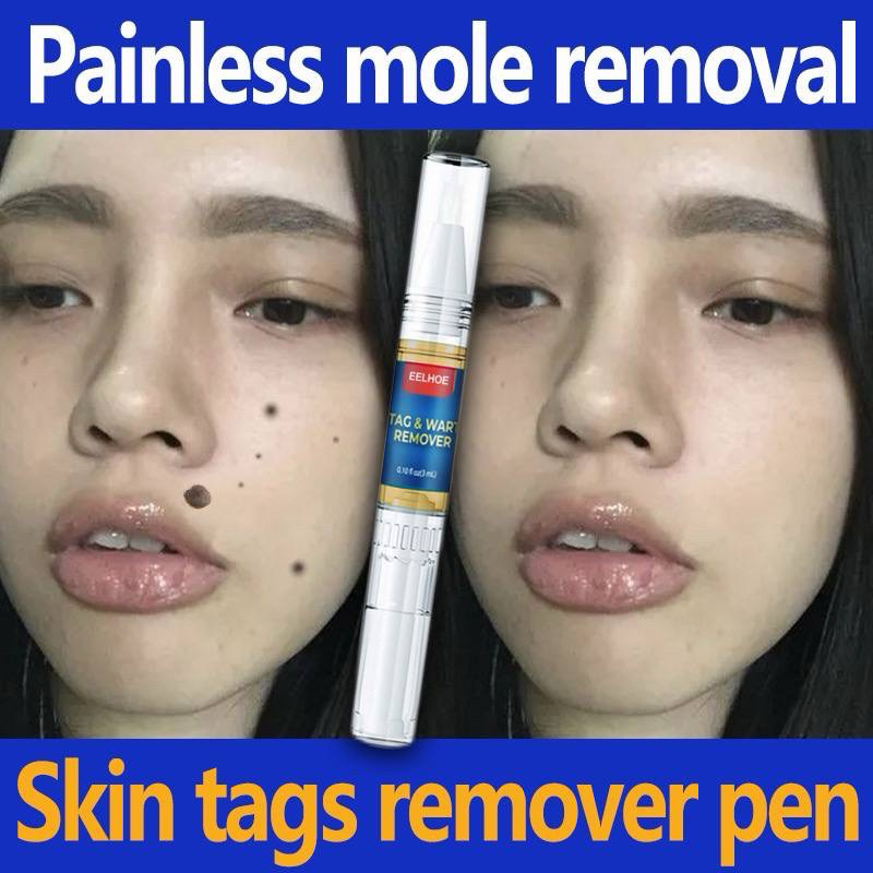 EELHOE SKIN TAG WART REMOVER penanggal ketuat kutil tahi lalat bintik ...
