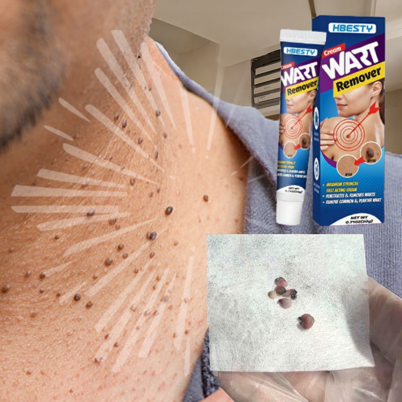 Warts Removal Cream ubat kutil tahi lalat ketuat dan biji kolesterol ...