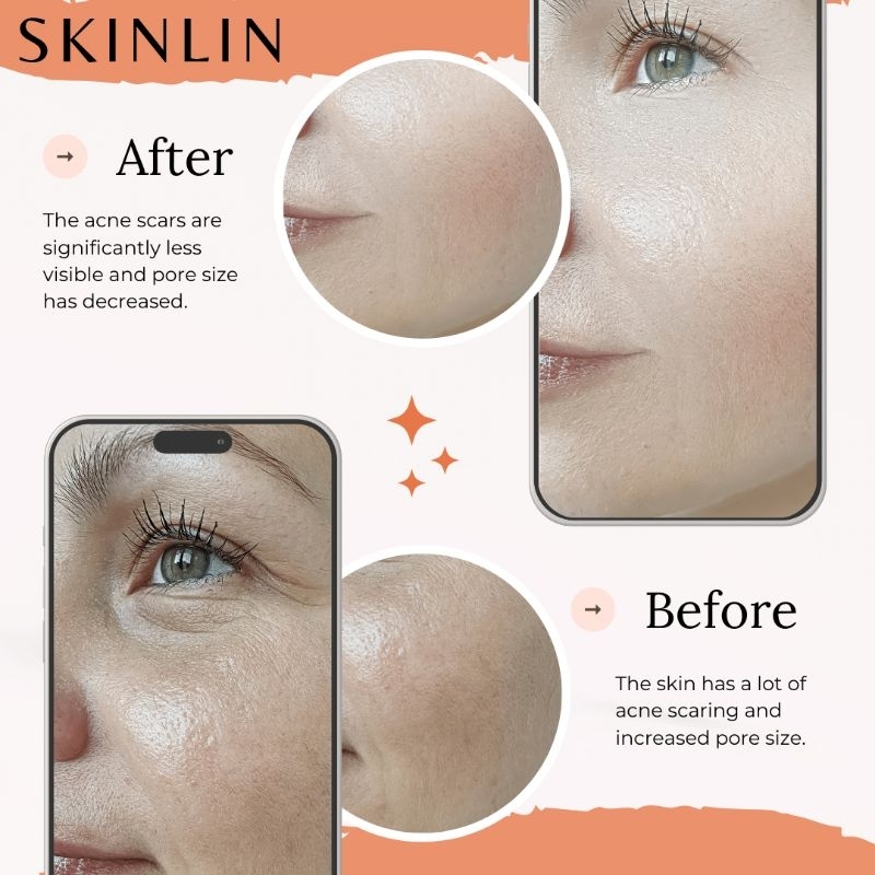 SKINLIN Aura Glow | 5x Ceramide | Deep Hydration for Crystal Bright ...
