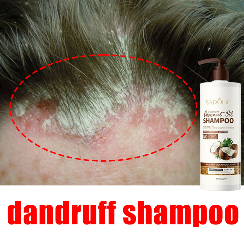 Shampoo Kelemumur Shampoo Dandruff Shampoo Coconut Shampoo Psoriasis Scalp Anti-Dandruff Oil ...