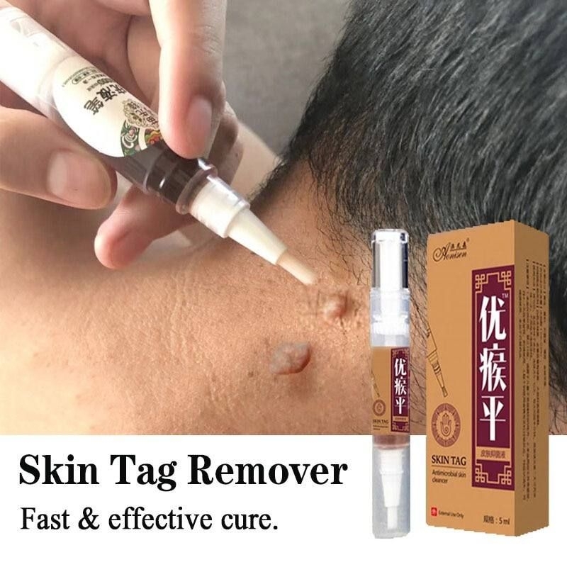 ONISEN SKIN TAG ANTIMICROBIAL SKIN CLEANCER pen menghilangkan ketuat ...