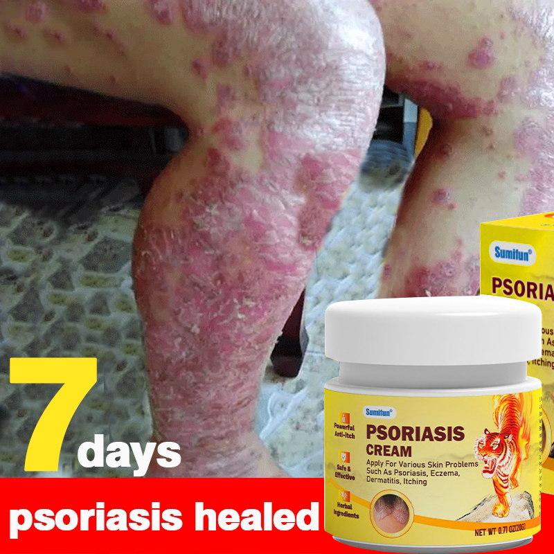 Ubat gatal Ubat kurap Psoriasis cream 20g Anti-Itch Remover Itchy Skin ...