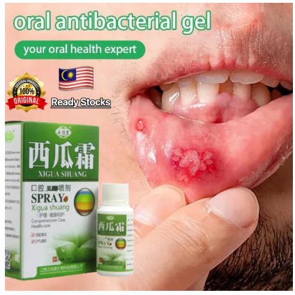 Oral Ulcer Spray Natural Herbal Mouth Ulcer care Spray 30ml Ubat ...