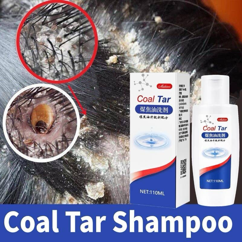 Anti Dandruff Coal Tar Shampoo Improve Itchy Head/ kelemumur psoriasis ...