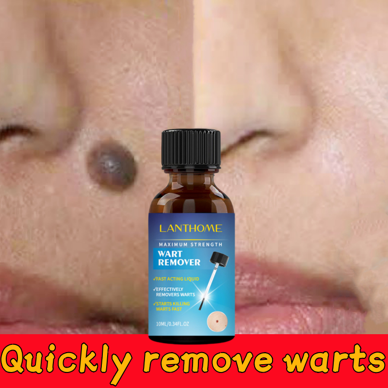 Wart Remover Ubat Ketuat Remover Ubat Kutil Removal Skin Tag Remover ...