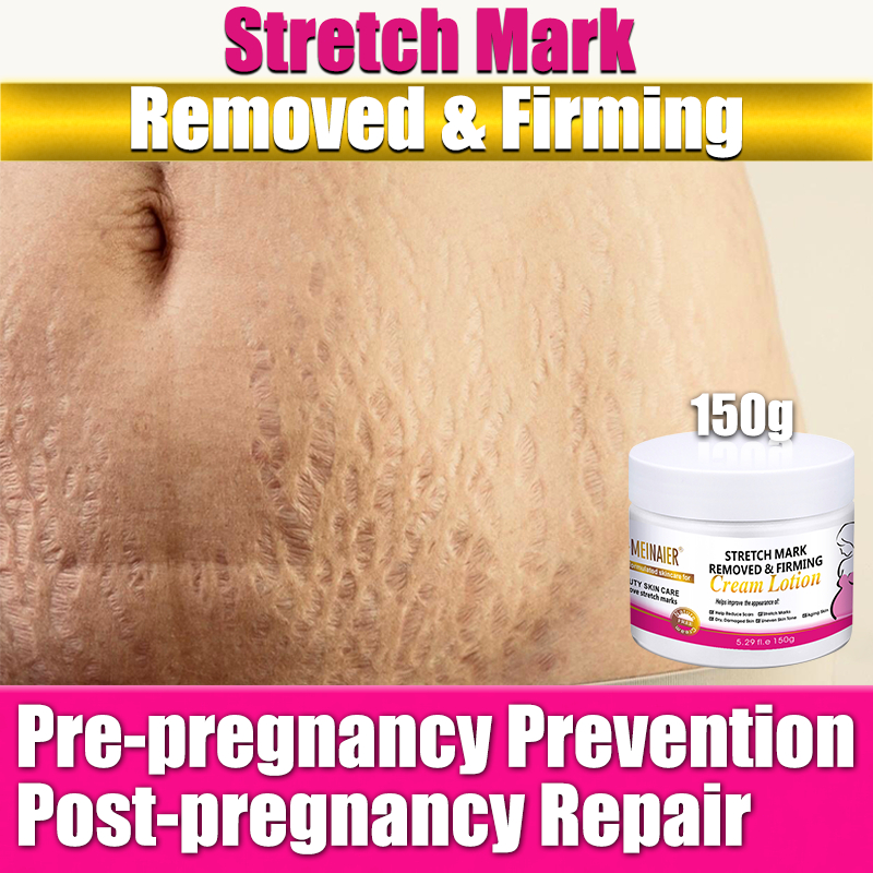 Stretch Mark Cream Stretch Marks Removed Firming Cream 150g Permanently ...