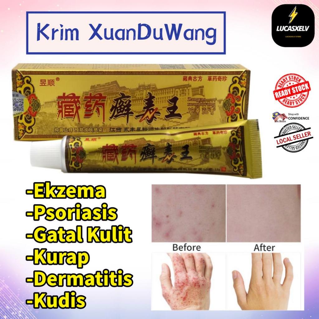 Ekzema Psoriasis Kurap Gatal Kulit Ubat Krim Herba Cina 15g / Eczema ...