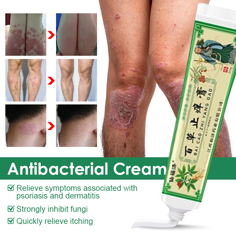 Krim gatal ubat gatal kulit eczema krim kurap dan gatal psoriasis cream Herbal antibacterial ...
