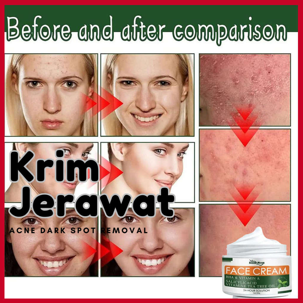 Acne Whitening Ubat Jerawat Krim Muka Acne Spot Treatment Krim Jeragat ...