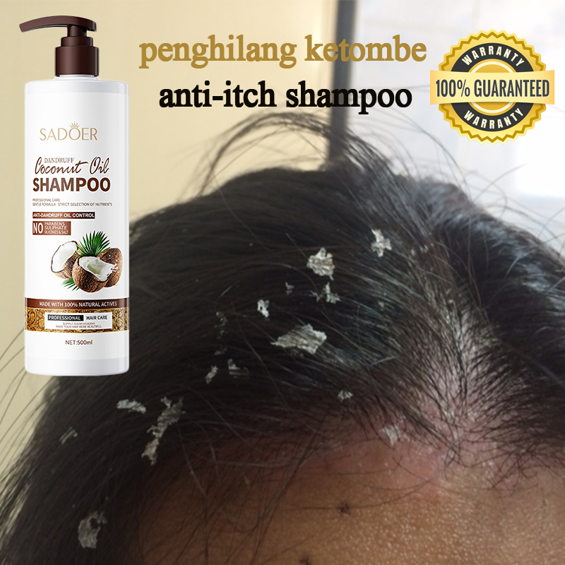 Syampoo kelemumur Coconut oil dandruff shampoo Itchy scalp kepala psoriasis shampoo 頭皮屑 洗發水 ...