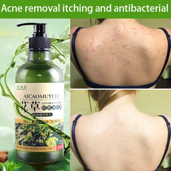 Acne body wash Antibacterial body wash 500ml Anti mite shower gel solve itching eczema acne ...
