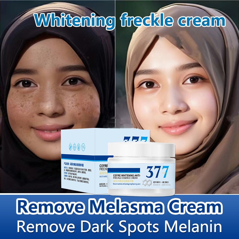 377 Whitening Freckle Removal Cream 50g Removes Dark Spots Freckles Sun ...
