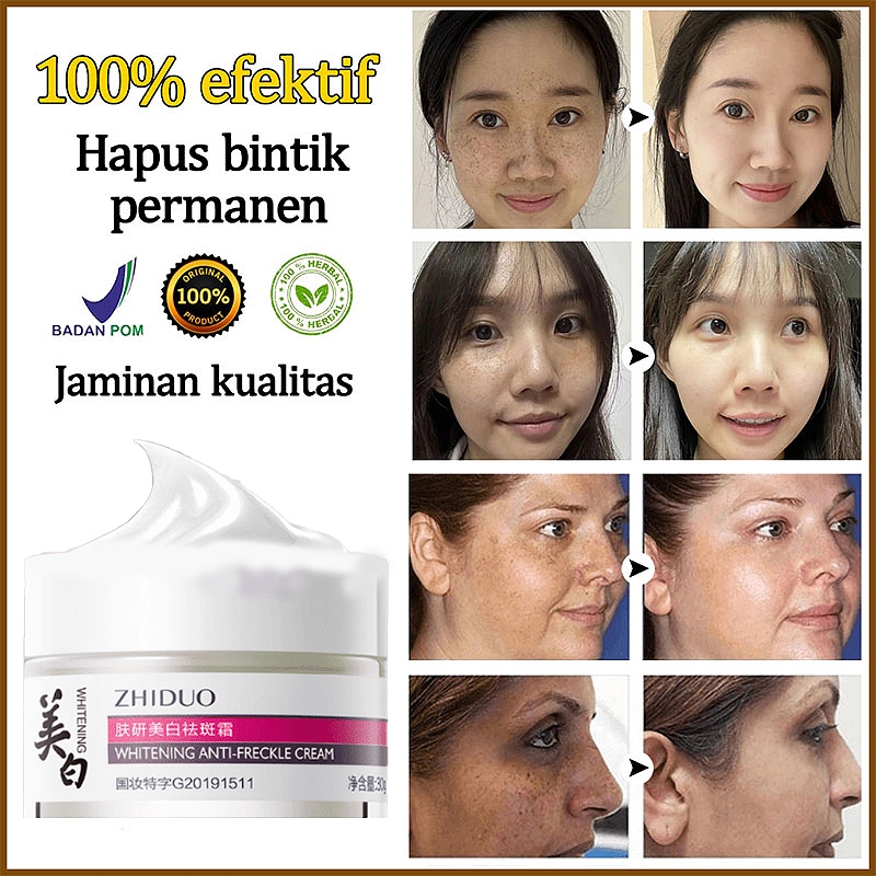 Whitening Freckle Cream Removal Chloasma Spots freckle remover cream ...