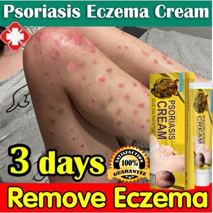 Ekzema Psoriasis Kurap Gatal Kudis Kayap Krim 20g NEW/Eczema Psoriasis ...