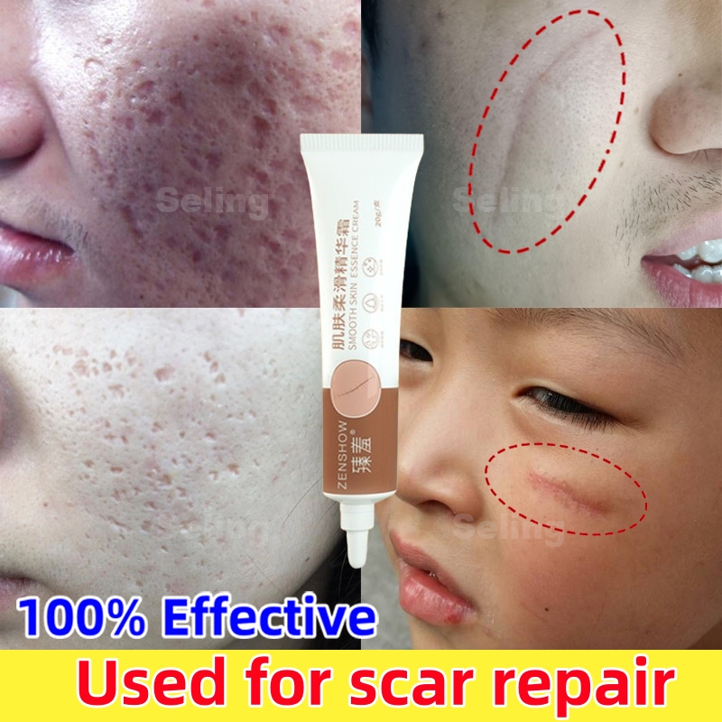 scar removal cream repair old scars stretch mark cream ubat parut ...