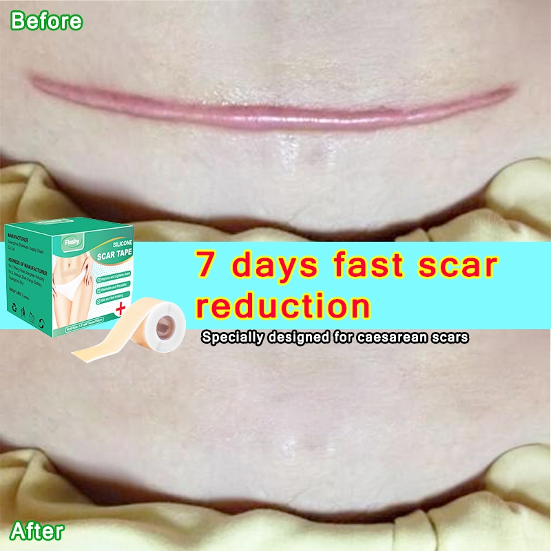 scar patch hilangkan parut hitam 4*150cm Menghilangkan bekas luka lama ...