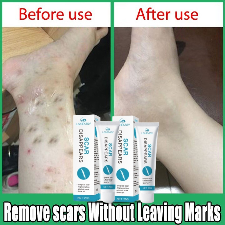Scar removal cream Krim hilangkan parut hitam Hilangkan parut kudis ...