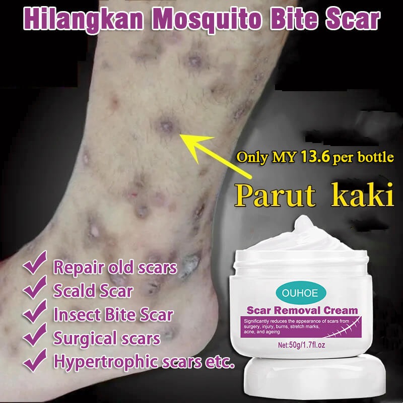 krim hilangkan parut hitam ubat hilangkan parut scar removal cream疤痕膏燙傷 ...