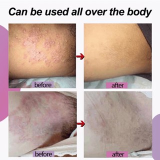 Private parts anti-itch cream private parts care cream remove itching ...