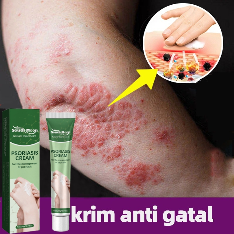 Psoriasis Eczema Cream ubat kulit gatal ekzema Antifungal Antibacterial ...