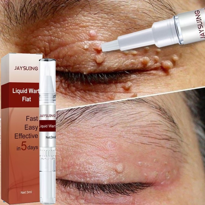 ubat ketuat biji kolestrol remover wart removal liquid pen Skin Tag ...