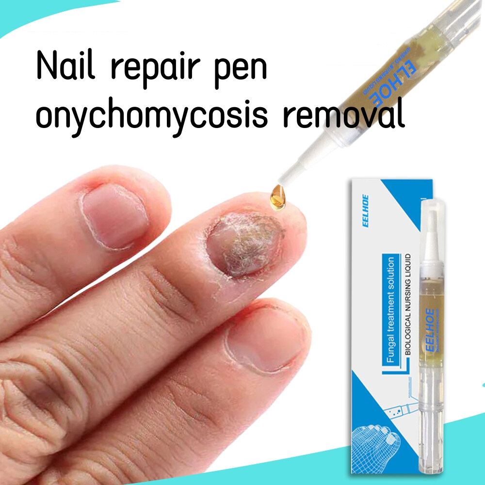 Ubat Kulat Kuku Nail Fungus Treatment Liquid Ubat Kuku Cekam Fungal ...