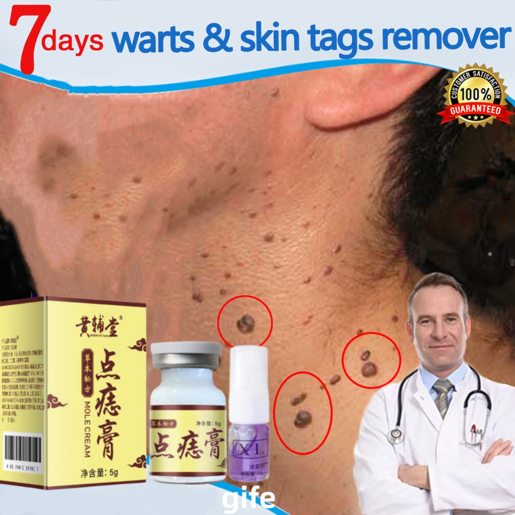 Mole Remover Cream Ubat Kutil Tahi Lalat Ketuat Dan Biji Kolesterol ...