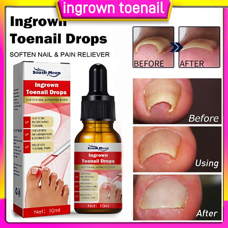 Ingrown Toenail Repair Serum nail repair oil Anti Paronychia ubat kulat kuku ubat kuku rosak ...