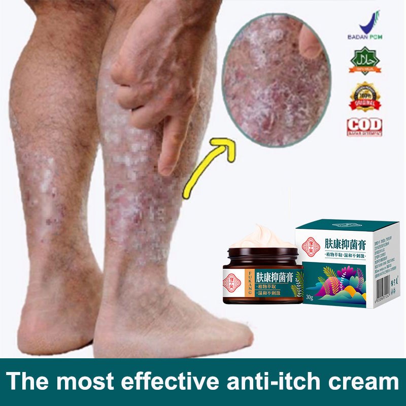 antifungal cream psoriasis cream eczema cream 30g Itching ringworm ...