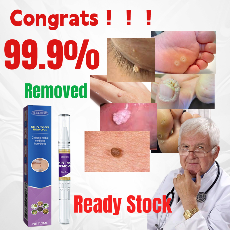 Ubat Ketuat Wart Remover Mole Remover Buang Tahi Lalat Dan Kutil Biji ...