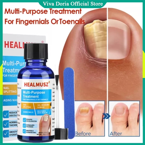 Anti Paronychia Relief Oil Nail fungus treatment ubat kuku cekam ubat ...