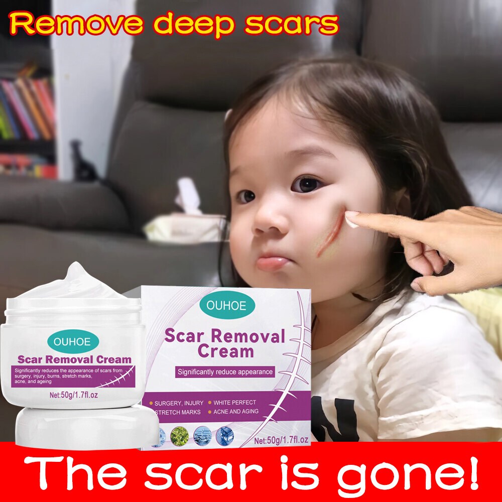 祛疤膏scar removal cream ubat hilang parut krim hilangkan parut kudis ...
