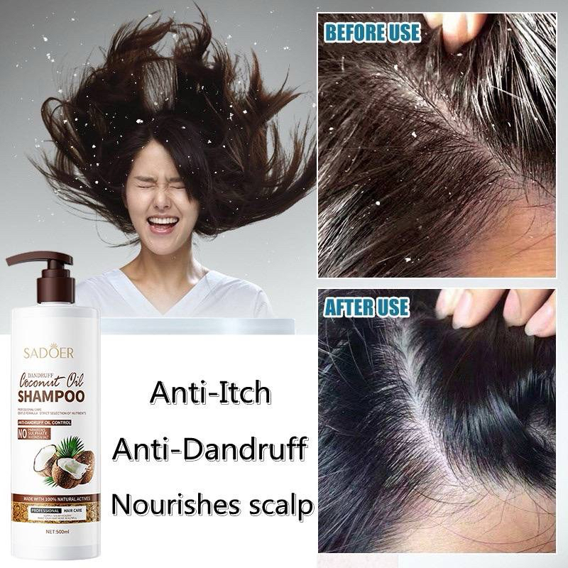 SADOER SHAMPOO ANTI DANDRUFF syampu anti kelemumur penghilang kelemumur rawatan kelemumur ...