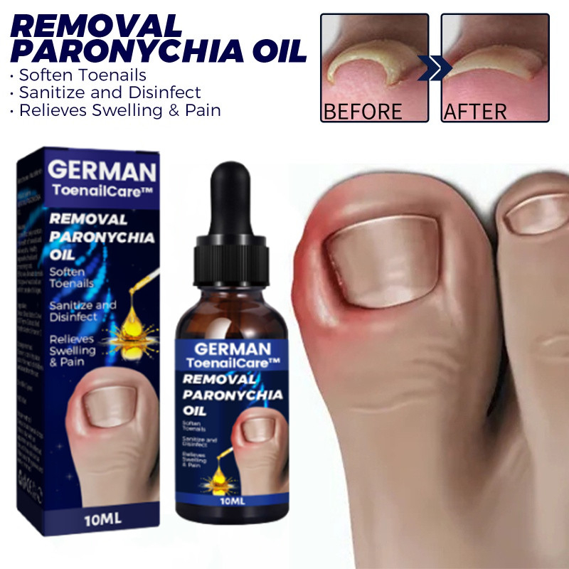 Ingrown Toenail Removal Paronychia Toenailcare Toenail Correction Nail ...