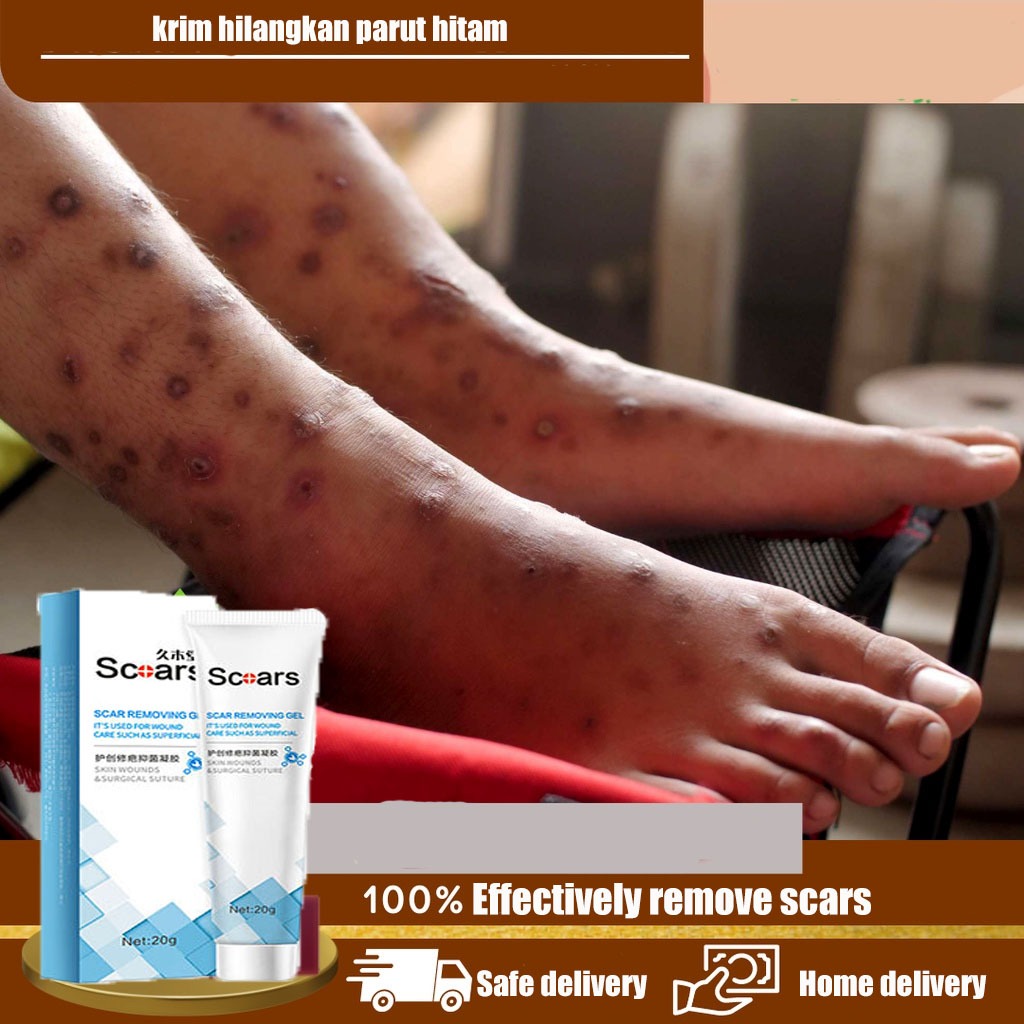 Krim hilangkan parut hitam Hilangkan parut kaki krim parut kaki ...