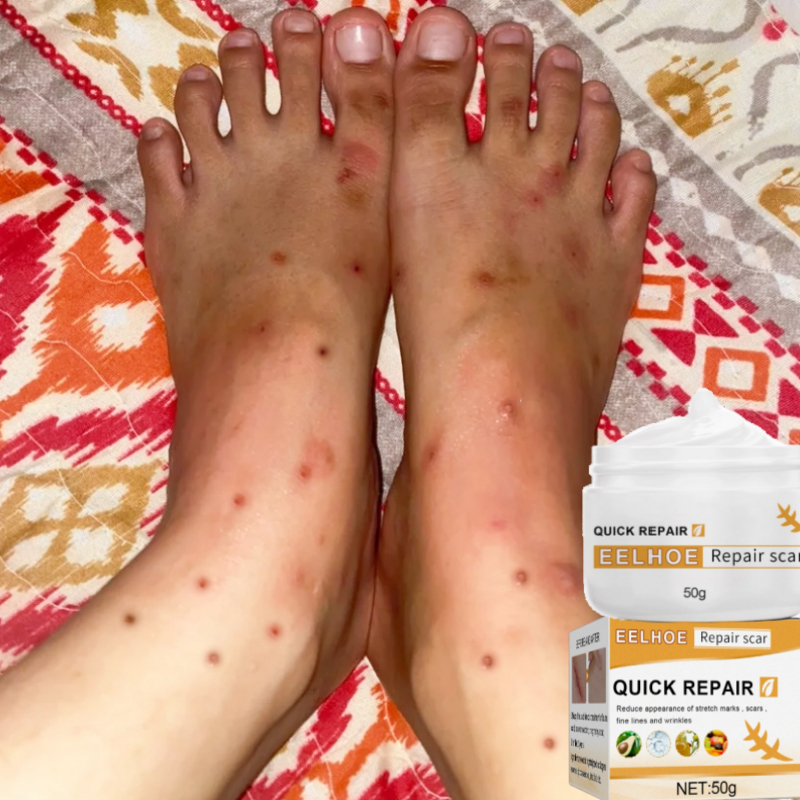 Krim hilangkan parut ubat hilangkan parut jerawat Mosquito bite scar ...