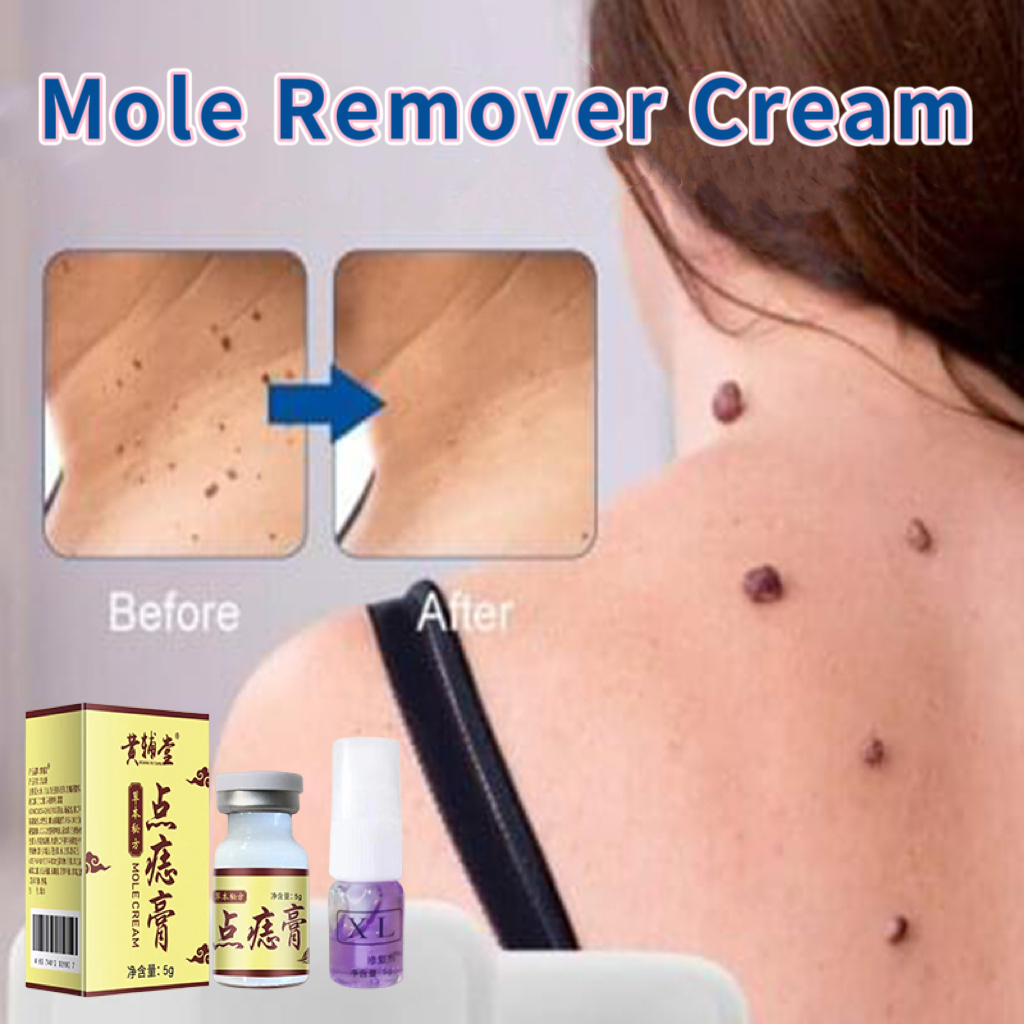 Mole remover cream warts removal skin tag remover skin tag melanin ubat ...