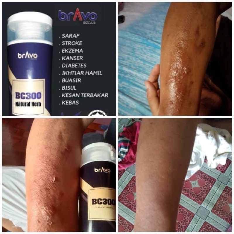 FREE SHIPPING BC 300 FREE SHIPPING BC300 KRIM MUJARAB BRAVO MERAWAT ...