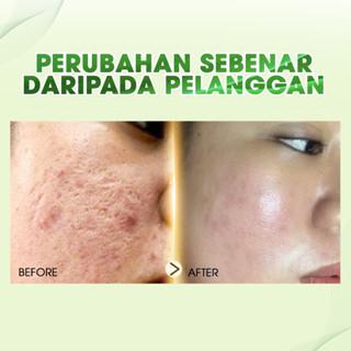Verble Serum Pitted Scar Reduce dark spots Brighten skin Regenerate ...