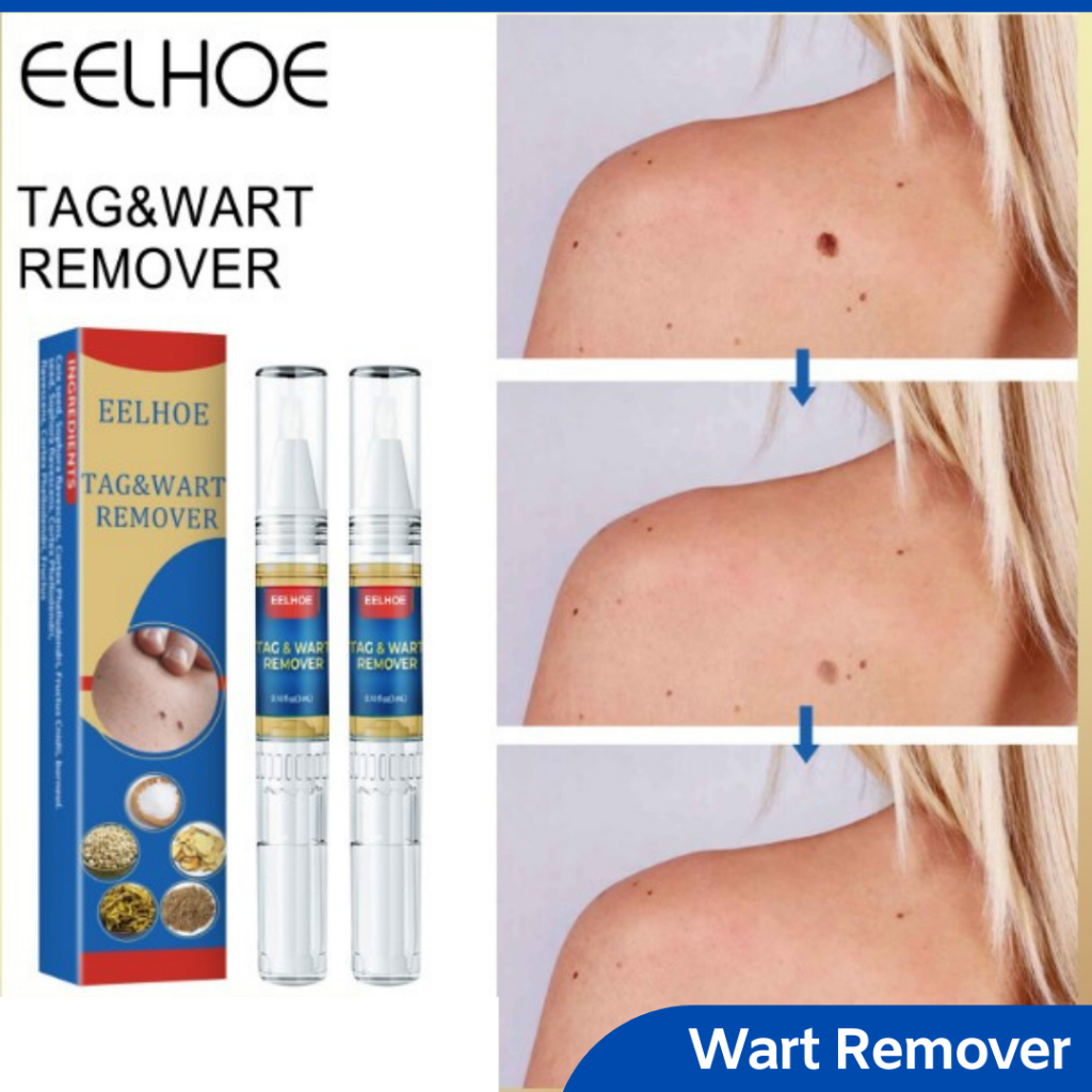 Ubat ketuat Tahi lalat Wart remover Buang tahi lalat dan kutil Biji ...