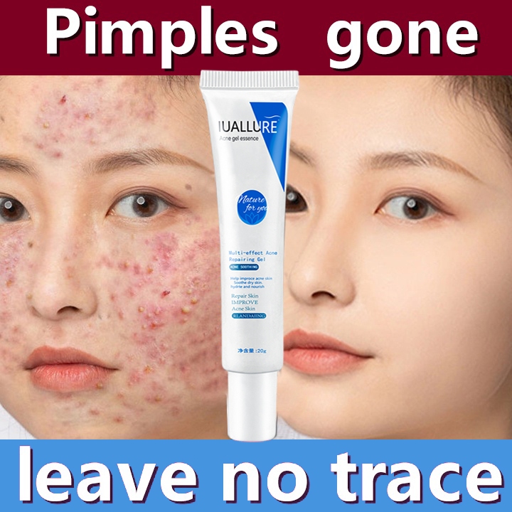 acne cream acne treatment Krim Ubat Jerawat Dan Parut Acne Scar Marks ...