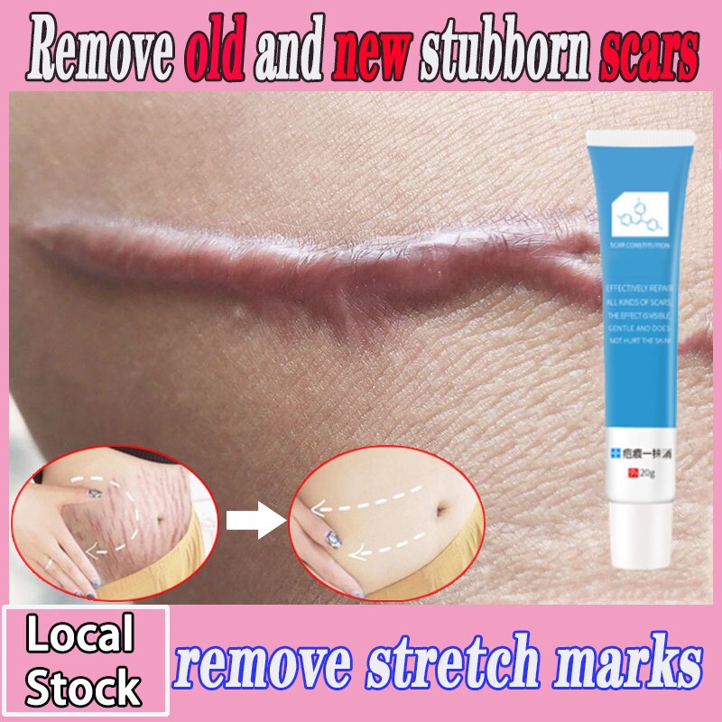 krim hilangkan parut scar repair hilang parut jerawat acne scar removal ...