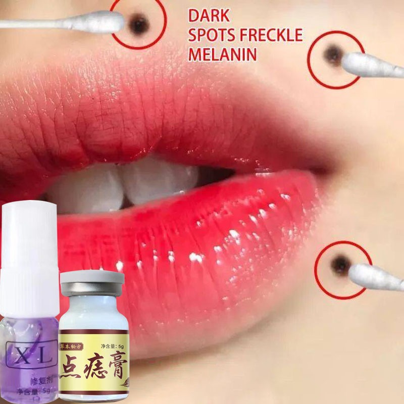 ubat kutil tahi lalat ketuat dan biji kolesterol Warts removal cream ...