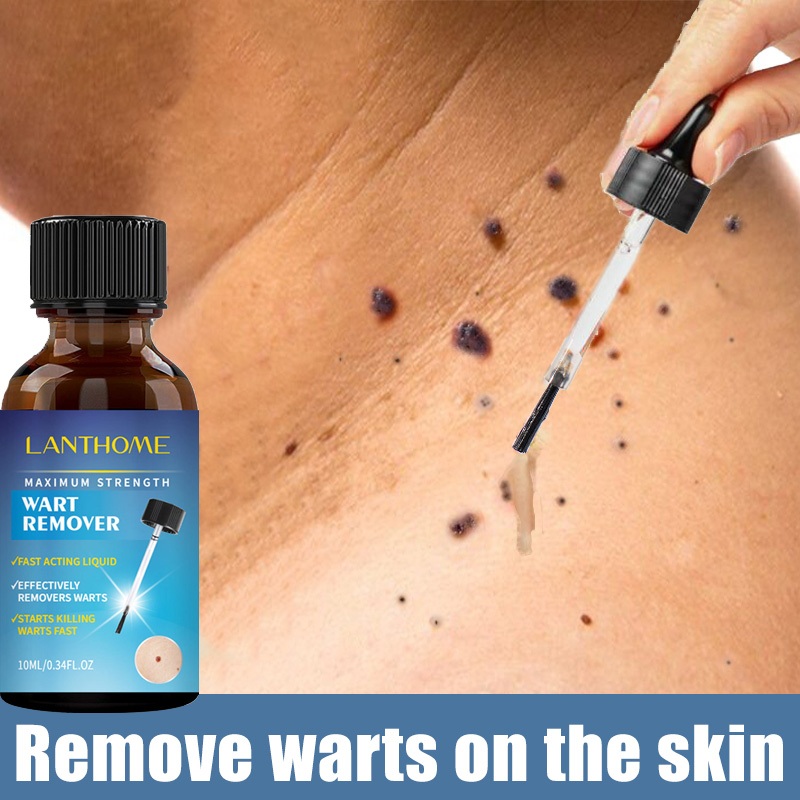 ubat tahi lalat ketuat remover wart removal liquid Buang tahi lalat dan ...