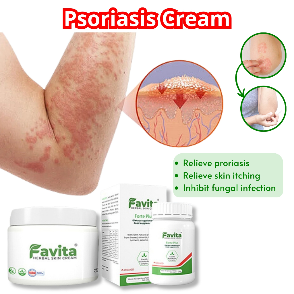 Favita Cream, Krim Gatal Kulit, Psoriasis Cream, Cream Eczema ...