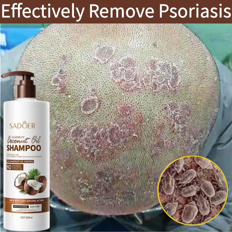 shampoo kelemumur dan gatal kepala Psoriasis shampoo Anti dandruff shampoo psoriasis scalp anti ...