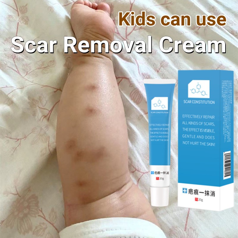 krim hilangkan parut scar repair hilang parut jerawat acne scar removal ...