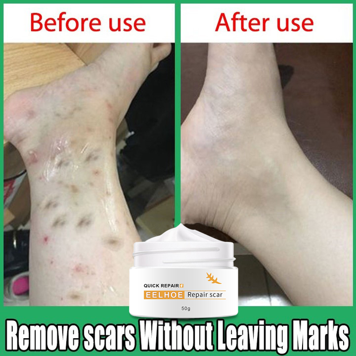 Ubat krim hilangkan parut hitam/bekas luka lama/parut kaki/Mosquito ...
