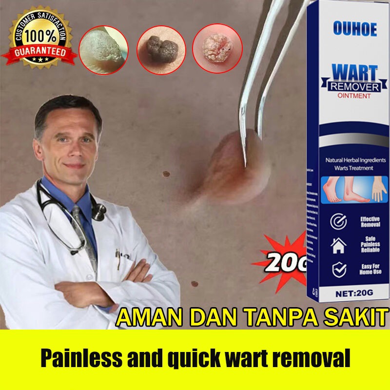 ubat ketuat tapak kaki krim buang tahi lalat buang kutil dan biji ...