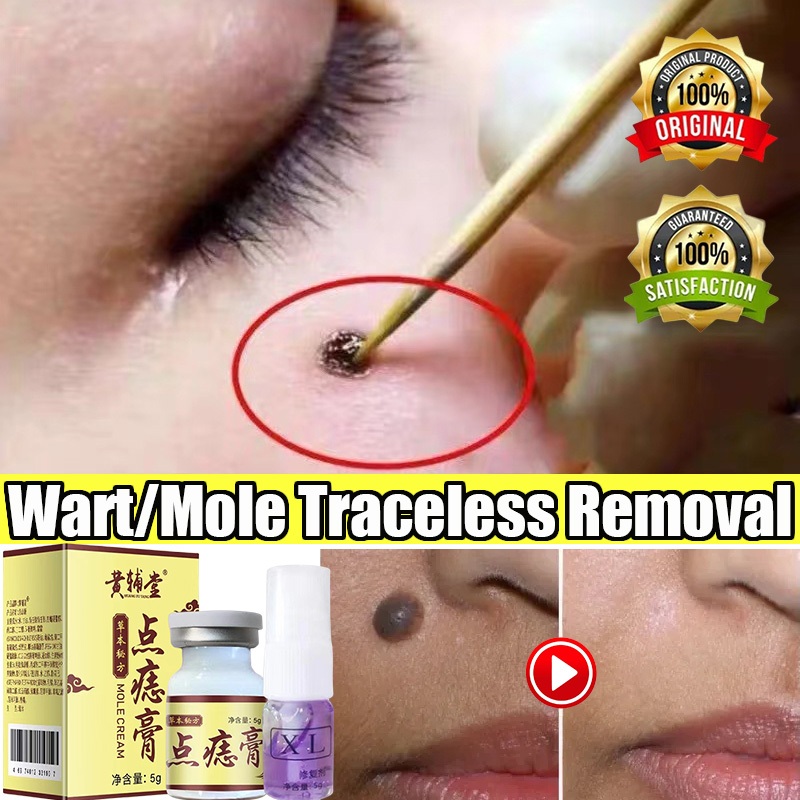 original skin tag remover cream ubat kutil buang tahi lalat warts ...